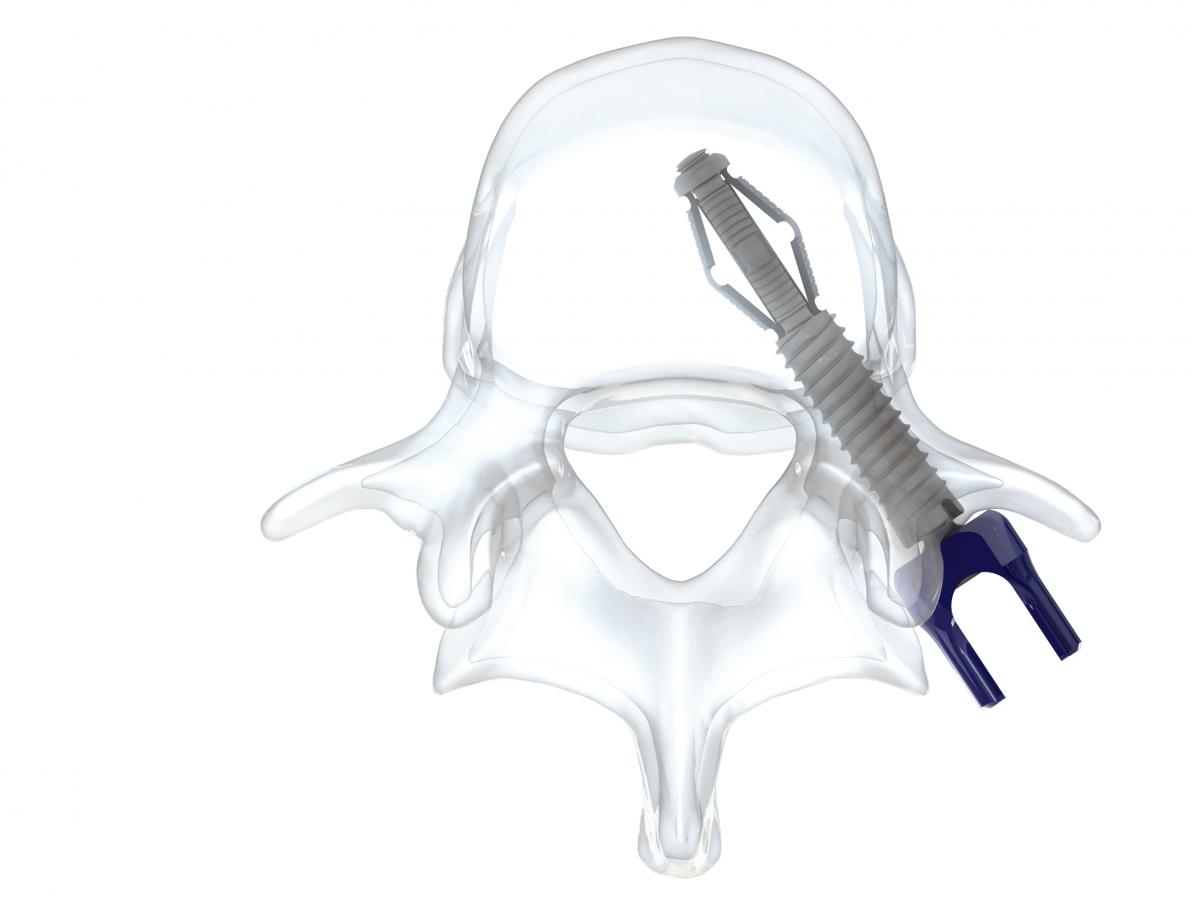 X-BOLT | Spinal DragonBolt™