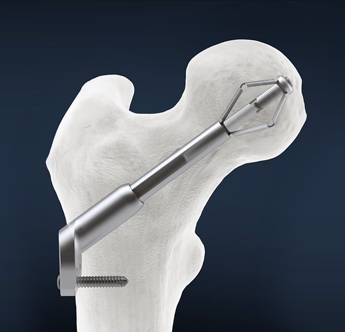 X-Bolt | Hip Fracture Fixation