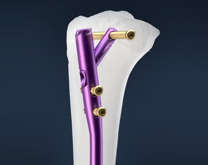 X-Bolt | Hip Fracture Fixation