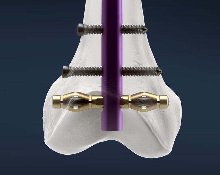 X-Bolt | Hip Fracture Fixation