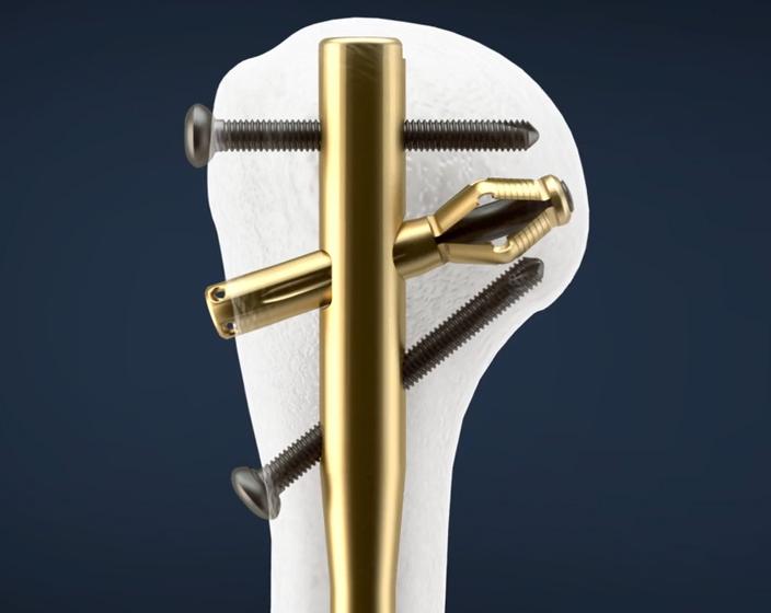 X-Bolt | Hip Fracture Fixation