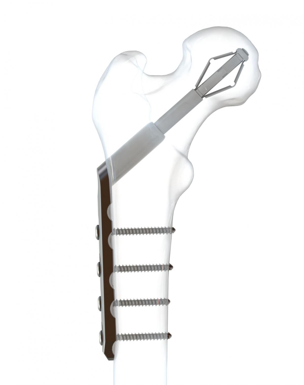 X-BOLT | XHS™ Dynamic Plating