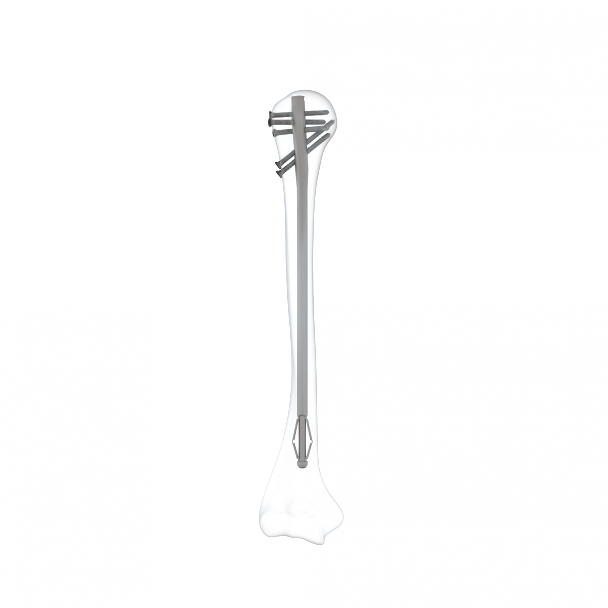 X-BOLT | Pendulum™ Humeral Nail